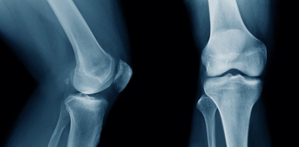 Revolutionary 'Bone Glue' Heals Fractures in Minutes, Not Months ...