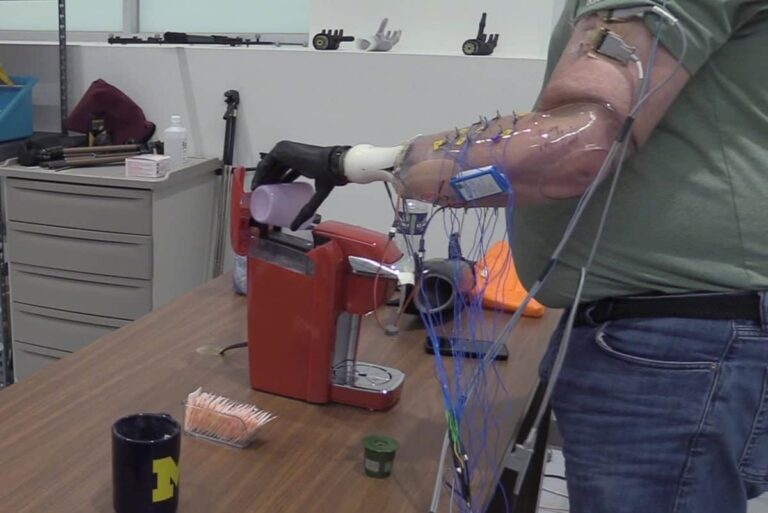 Implanted Electrodes Revolutionize Control of Prosthetic Hands ...